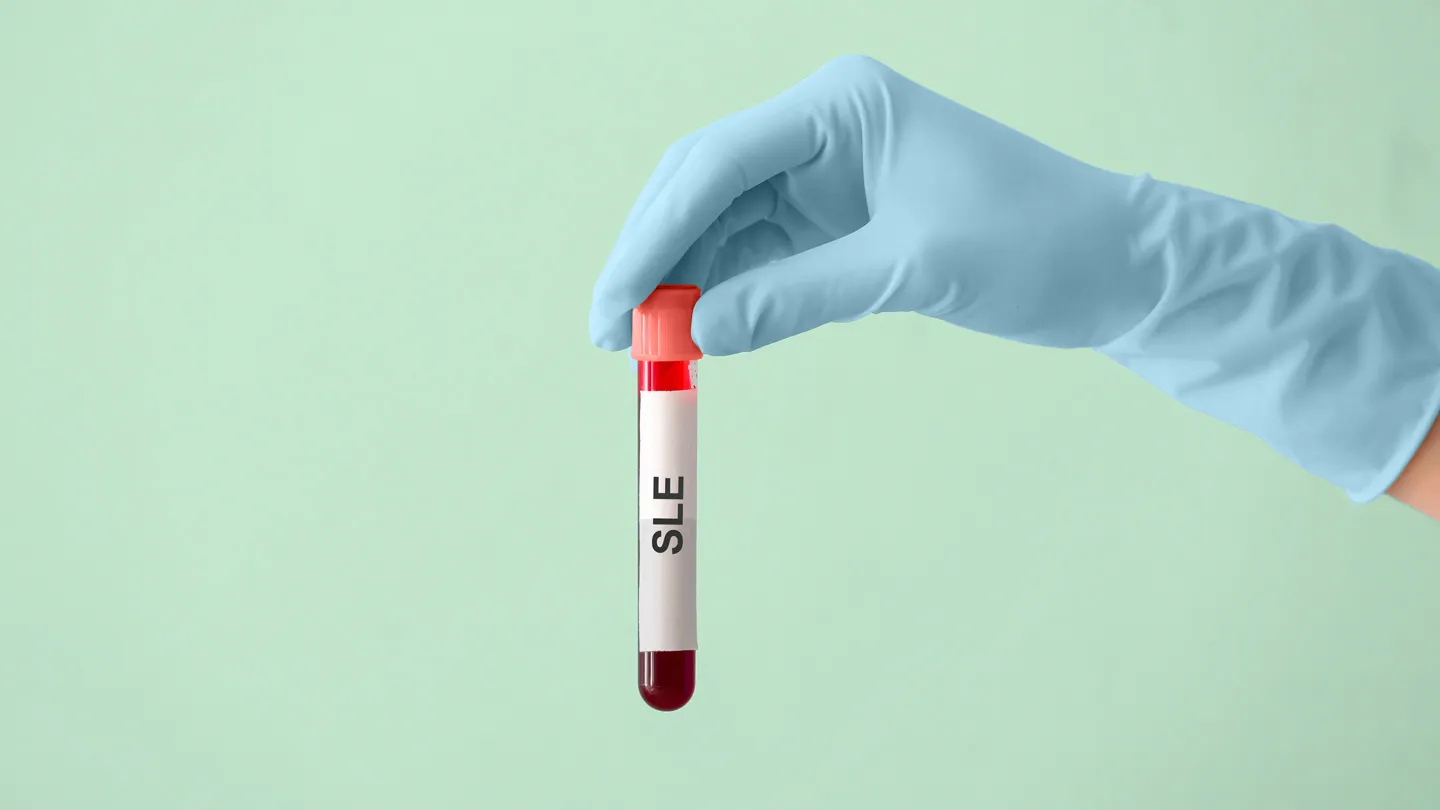 Different Types of Lupus and How They’re Treated - fit.pixfw.com